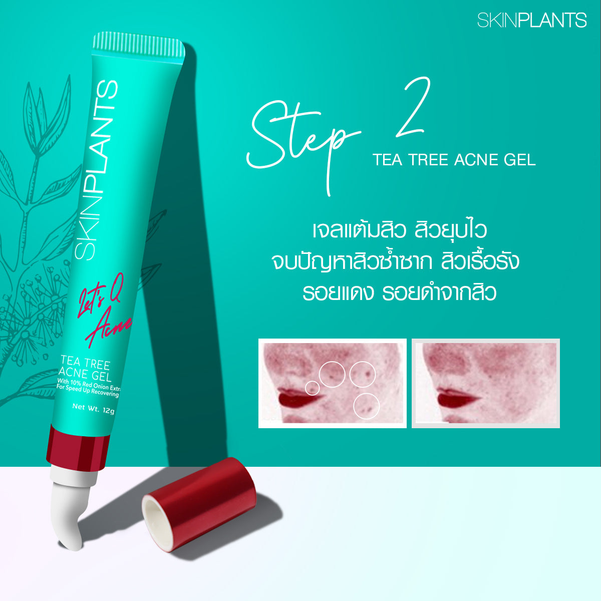 Tea Tree Acne Gel – Skinplants